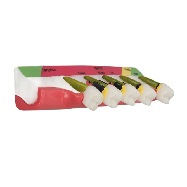 DISEASE DISPLAY MODEL Tooth Model Dental Teeth Power Dental Flossers ...