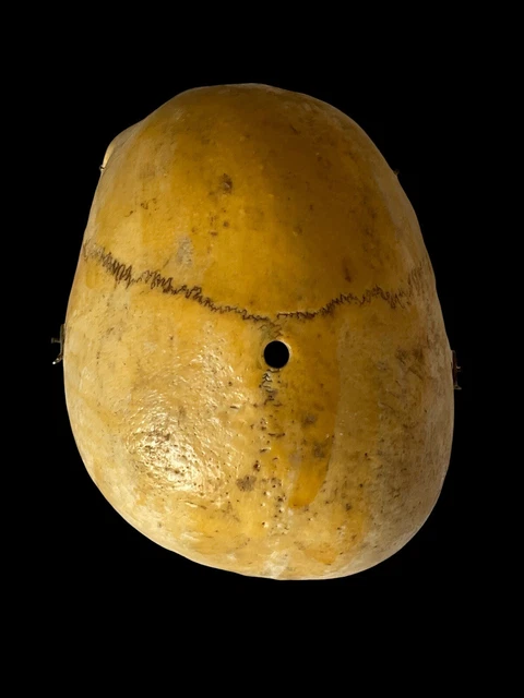 RARE CRÂNE HUMAIN Human Skull Medical Modèle Anatomique DÉFORMÉ ...