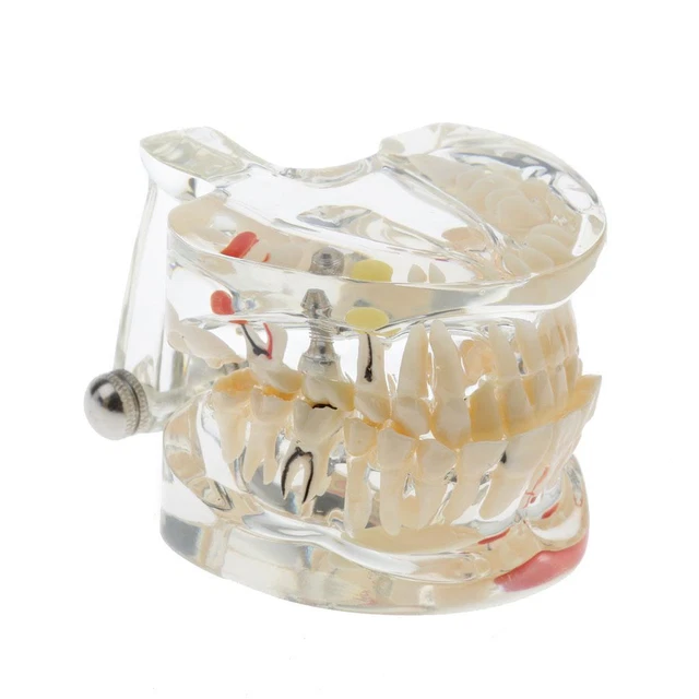 DENTAL IMPLANT Teeth Model Dentist Removable Tooth Model Tool Clear £24 ...