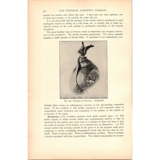 THE TESTICLE ATROPHY Torsion Of Testicle 1928 Urology Book Plate Print ...