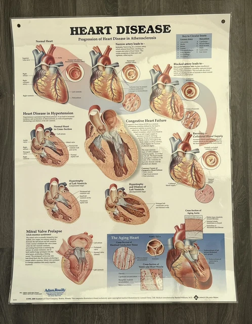 ANATOMICAL CHART COMPANY Heart Disease Anatomical Wall Chart £10.00 ...