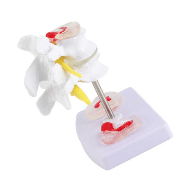 ANATOMICAL LUMBAR DISC Herniation Demonstration Model Human Spine ...