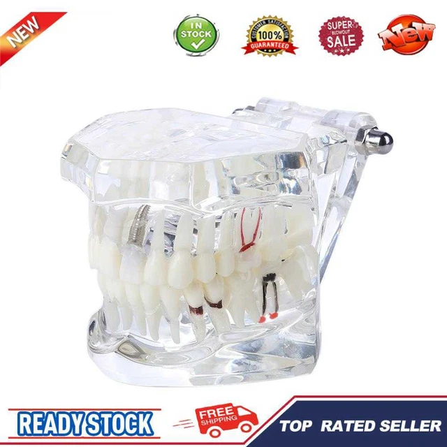 PVC TOOTH DECAY Model Occlusal Oral Tooth Models Removable Medical ...