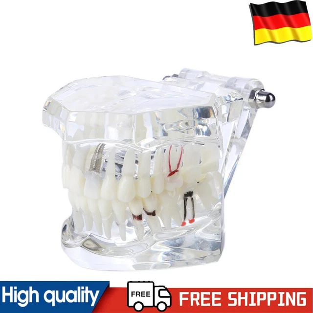 PVC TOOTH DECAY Model Oral Health Care Tooth Implant Model Medical ...