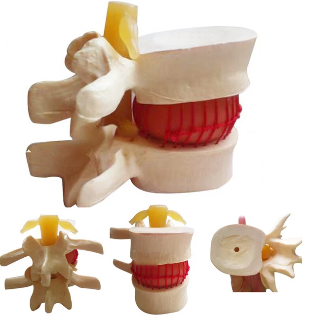 SPINE LUMBAR DISC Herniation Model Demonstration Medical Model £19.86 ...