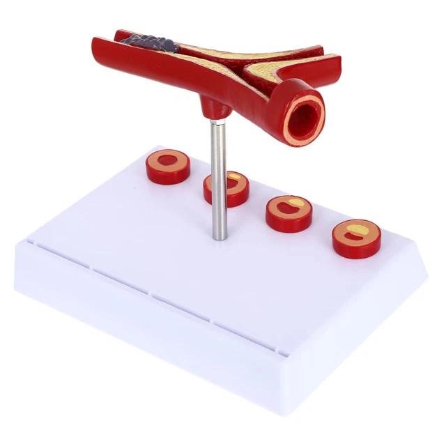 BLOOD VESSEL ANATOMY Model with Plaque Anatomical Pathology Liver £29. ...