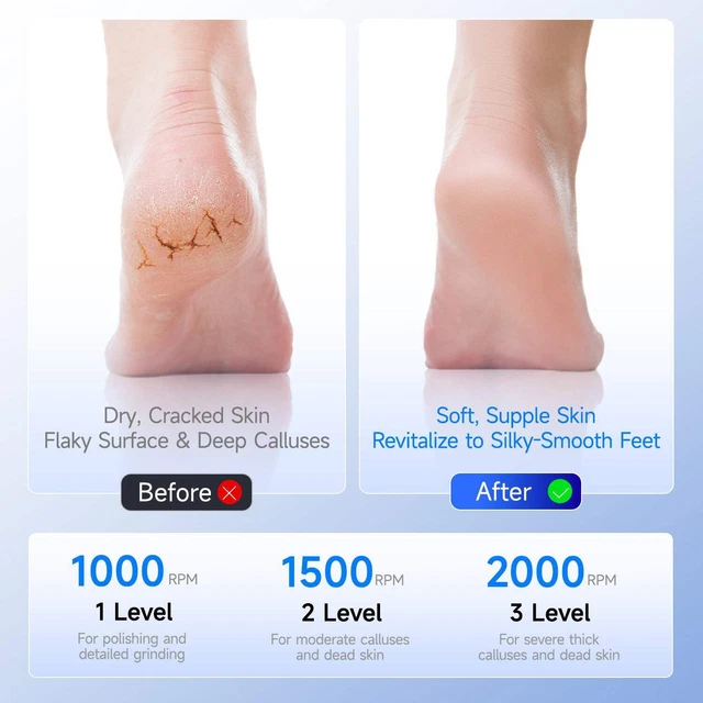 WHITE A1 COMPACT Electric Foot Dead Skin and Callus Remover - IPX6 ...