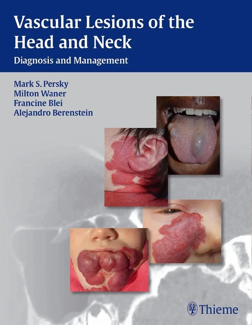 VASCULAR LESIONS OF the Head and Neck | Diagnosis and Management ...