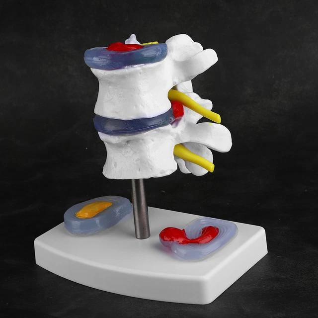 Disc Herniation Model Human Lumbar Demonstration Model Of Lumbar Lumbar ...