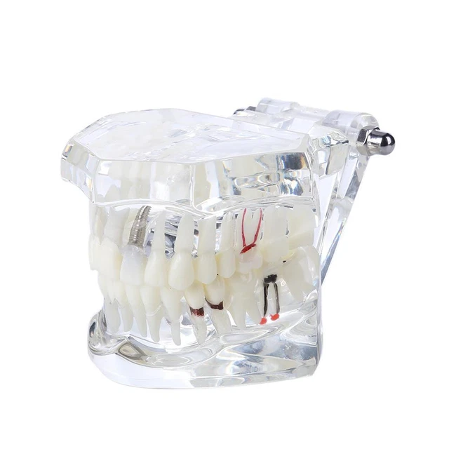 PVC DENTAL CONSUMABLE Teeth Models Occlusal Small Dental Model Dental ...