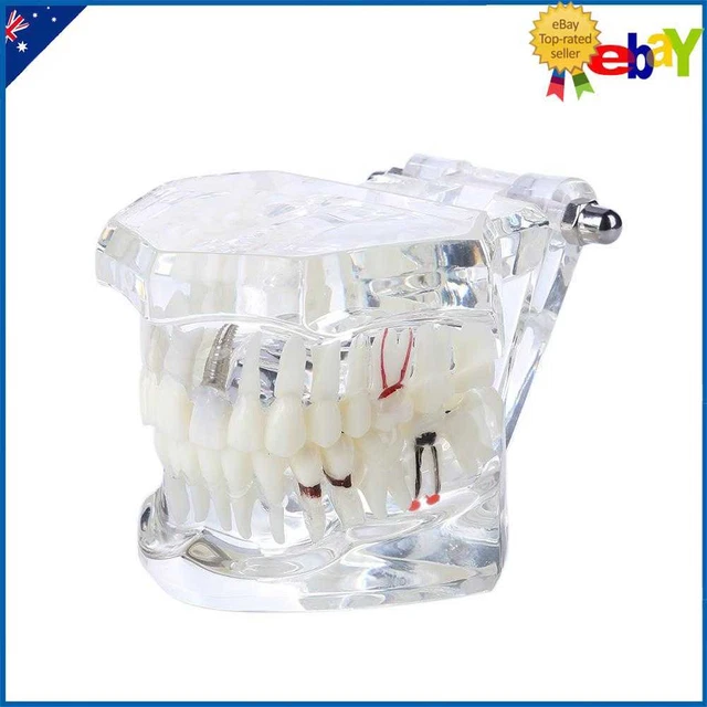 PVC TOOTH IMPLANT Model Occlusal Small Dental Model Useful Medical ...