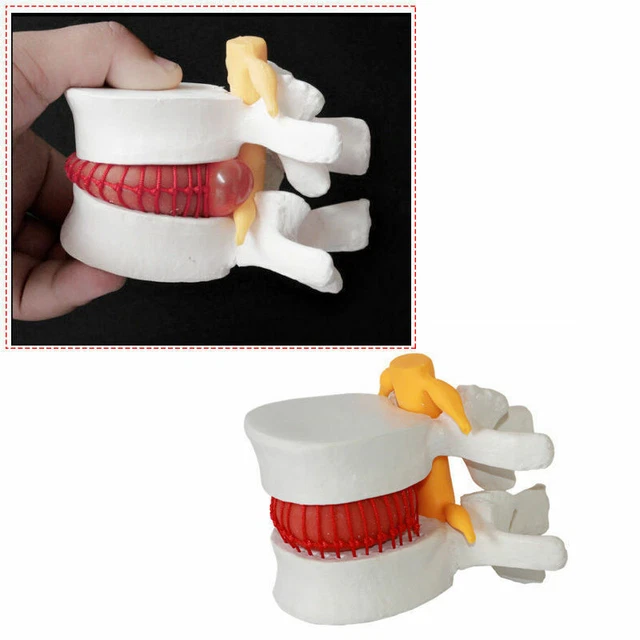HUMAN LUMBAR DISC Herniation Demonstration Model of Lumbar Vertebral ...