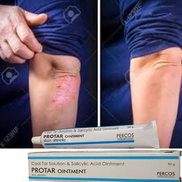 3 PACK PROTAR OINTMENT Coal Tar Cream Ointment Psoriasis Dry Skin 50 gm ...