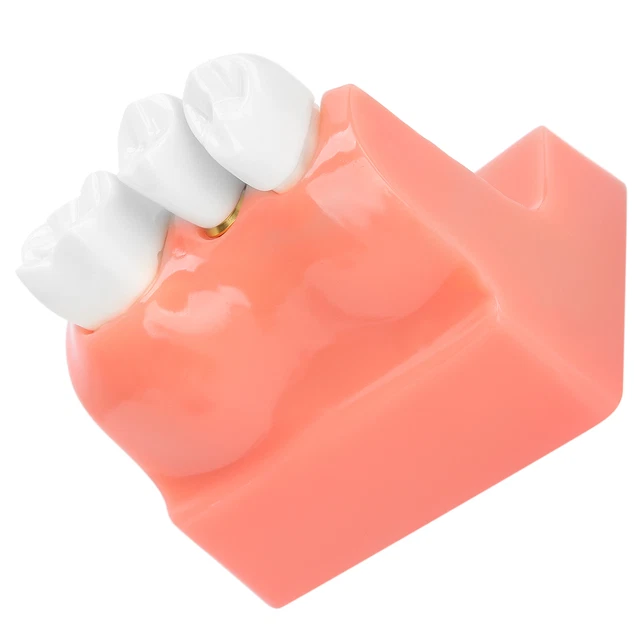 TEETH MODEL DENTAL Implant Analysis Crown Bridge Model Demonstration ...