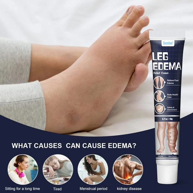 LEG EDEMA RELIEF Cream Effective Foot Swelling Reduction Natural ...