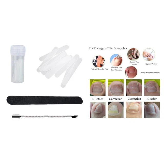 PROFESSIONAL TOE NAIL Splint Treatment Clipper Kit £5.75 - PicClick UK