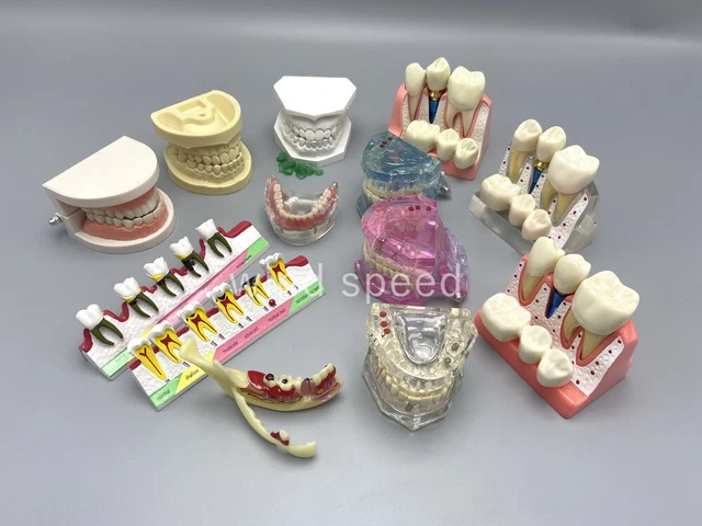 DENTAL STUDY TEACH Implant Teeth Model Restoration Bridge Caries ...