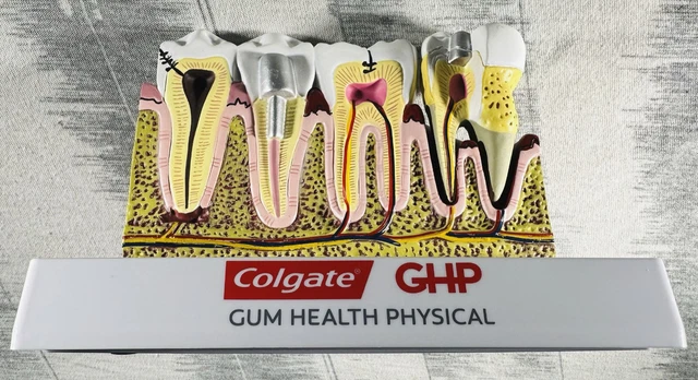 COLGATE DENTAL CARIES Comparison Teeth Model Dental Anatomy Teaching ...