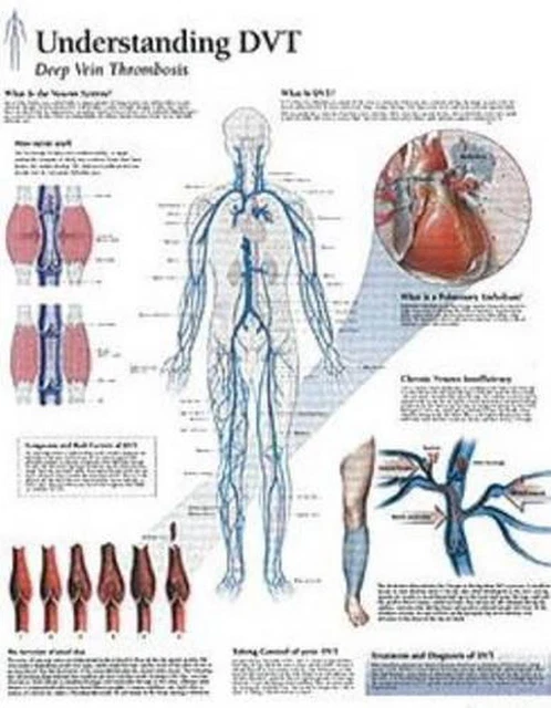 UNDERSTANDING DVT LAMINATED Poster by Scientific Publishing (English ...