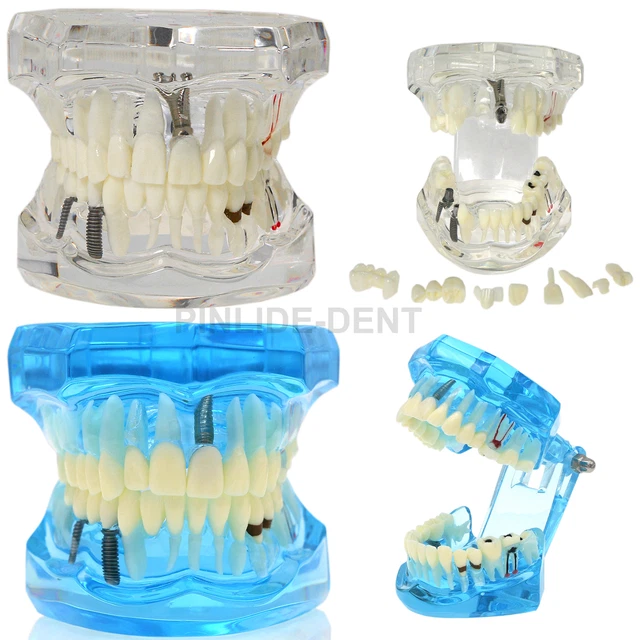 DENTAL IMPLANT TEETH Model Restoration Pathology Teach Study Demo ...