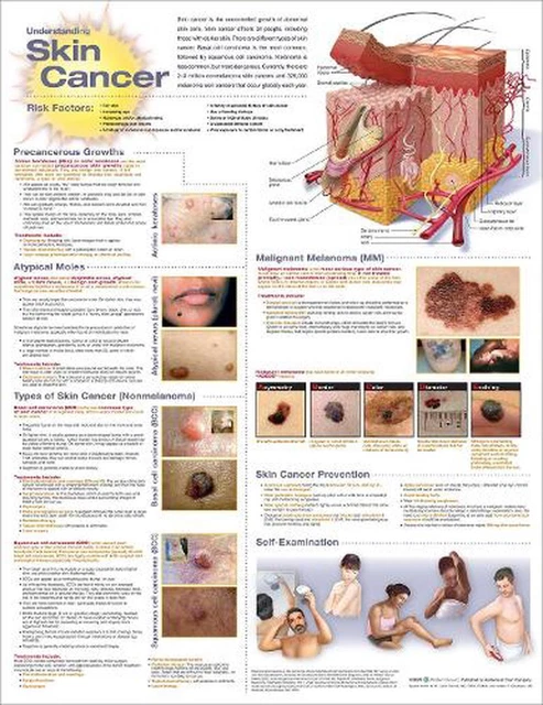 UNDERSTANDING SKIN CANCER Anatomical Chart by Anatomical Chart Company ...