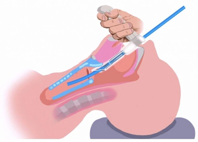 Endotracheal Tube Stylet