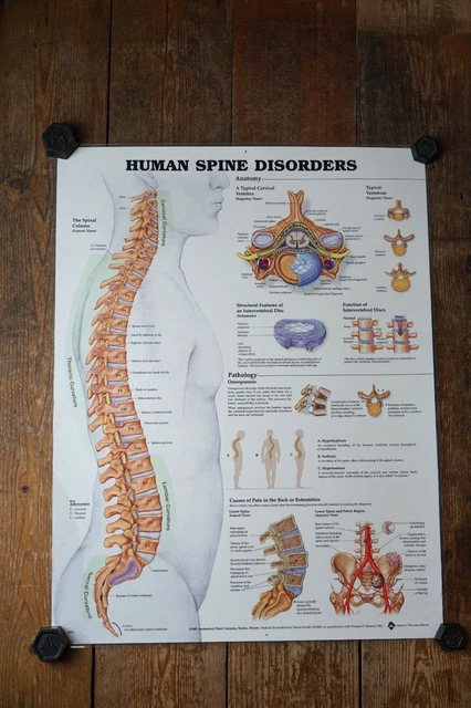MEDICAL ANATOMICAL HUMAN Spine Disorders Educational Laminated Wall ...