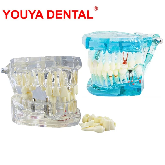 DENTAL TEETH MODEL Study Implant Restoration Teaching Bridge Tooth ...