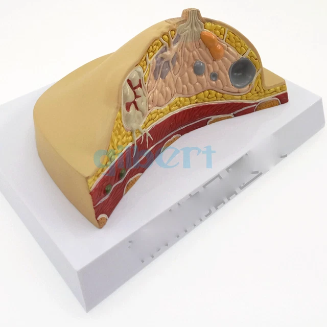 ANATOMICAL HUMAN PATHOLOGICAL Breast Model Medical Disease & Cancer ...
