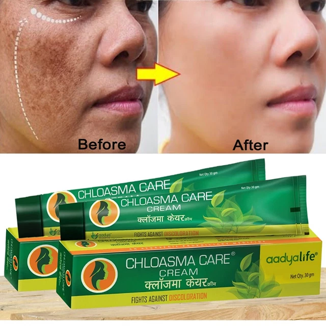 HYPERPIGMENTATION, BLEMISHES REMOVAL Chloasma Care Herbal Cream, 30g x ...