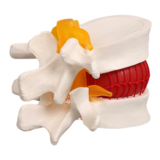 ANATOMICAL LUMBAR DISC Herniation Model Lumbar Spine Model Disc ...
