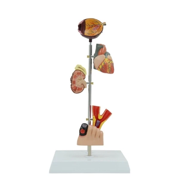 HUMAN PATHOLOGICAL KIDNEY Model, Diabetes Pathology Demonstration Model ...