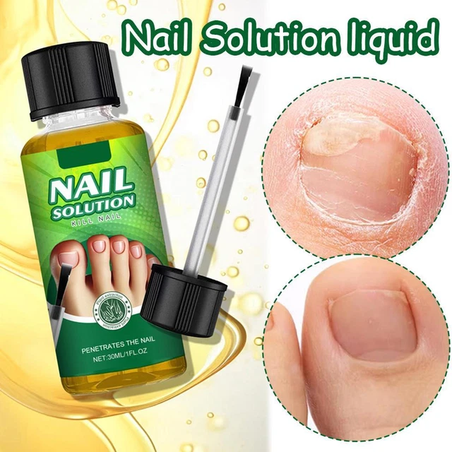 NAIL EFFECTIVETREATMENT ANTI Fungal Toe Removal Infection Repair Liquid ...