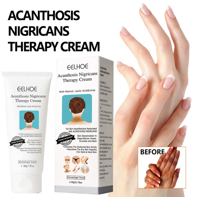 DARK SPOT ARMPIT Corrector Joint Nigrifree Acanthosis Cream Arms ...