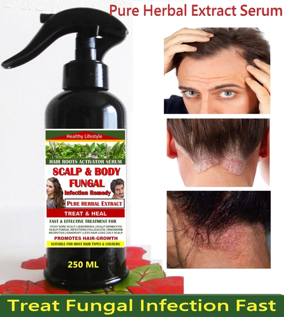SUPER FAST SOLUTION Scalp Psoriasis Tinea Capitis Ringworm- Herbal ...