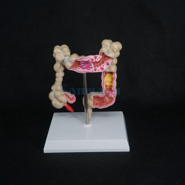 ANATOMICAL HUMAN COLON Intestine Pathological Diseases Model Medical ...