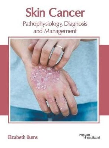 SKIN CANCER: PATHOPHYSIOLOGY, Diagnosis and Management by Burns ...