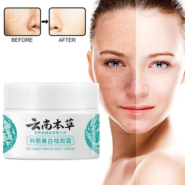 JAPANESE MELASMA CREAM, Cream Japan,Dr Hancy White Spot Face Freckle ...