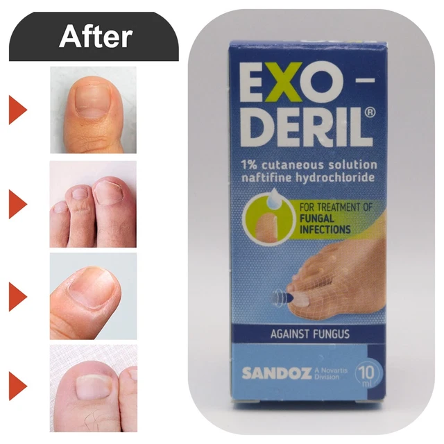EXODERIL 1% 10ML Anti Fungal Nail Treatment Fungus Solution Finger Toe ...