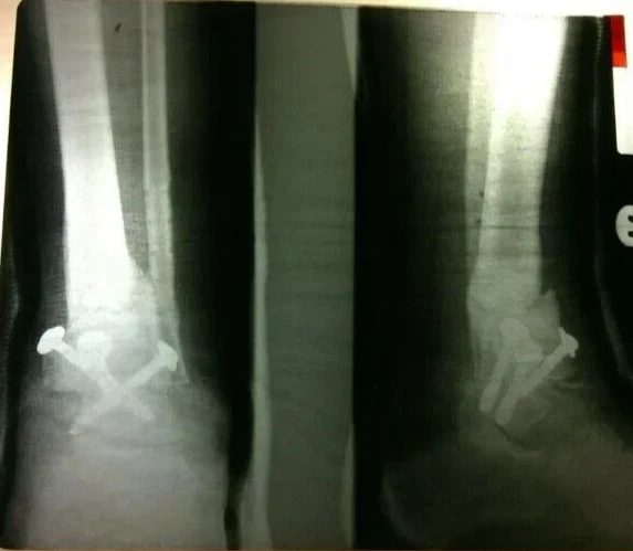 BODY ANATOMY X-RAYS Human Leg Ankle Tibia Fibula Fracture Lateral ...