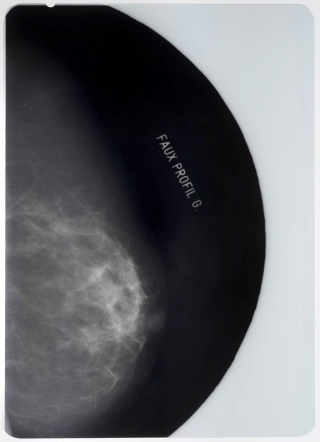 GENUINE VINTAGE HOSPITAL X-Ray Human Breast Mammogram Original Acetate ...