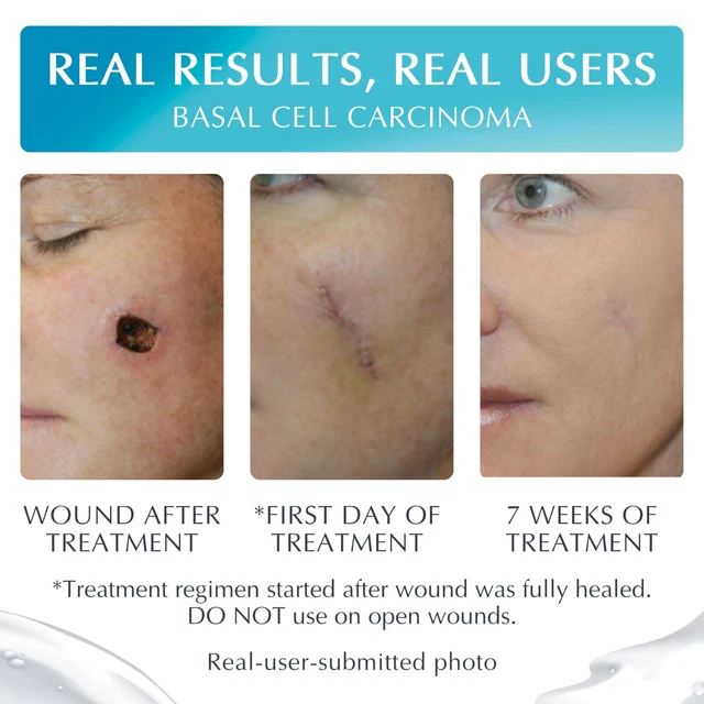 ADVANCED HIGH-POTENCY SILICONE Scar Gel with Vitamin E for Old, New ...