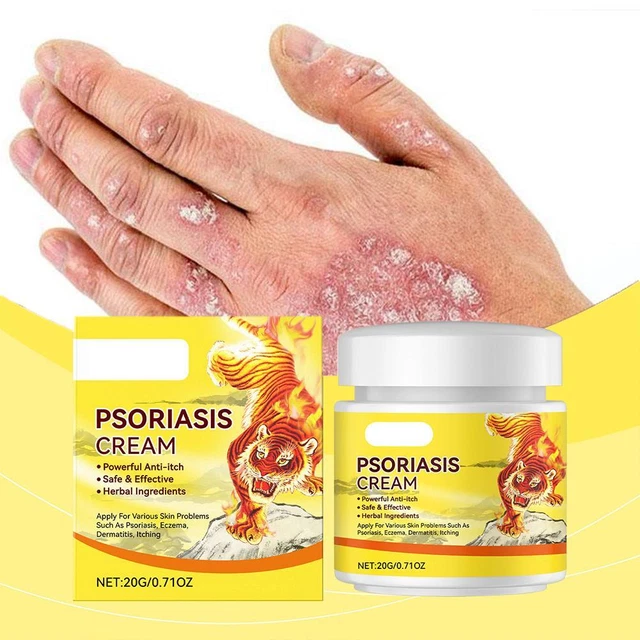 PSORIASIS CREAM DERMATITIS Pruritus Eczema Ointment Skin Anti Itching N9K4 B4J1 £4.03 - PicClick UK