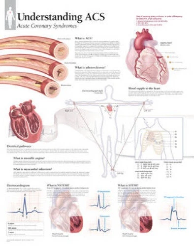 UNDERSTANDING ACS (ACUTE Coronary Syndrome) Laminated Poster $39.24 ...