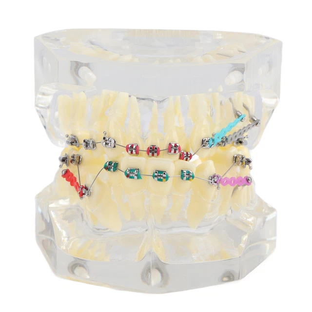 DENTAL ORTHODONTIC TREATMENT Malocclusion Study Teeth Model With Wire ...