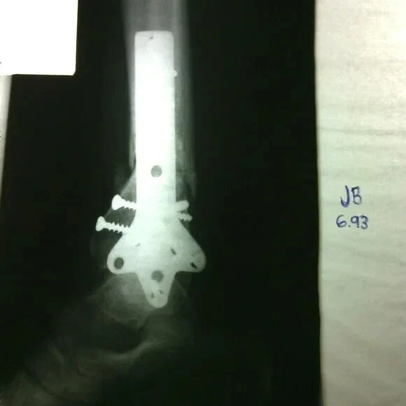 HOSPITAL MEDICAL X-RAYS Human Anatomy Leg Ankle Plate Fracture Tibia ...