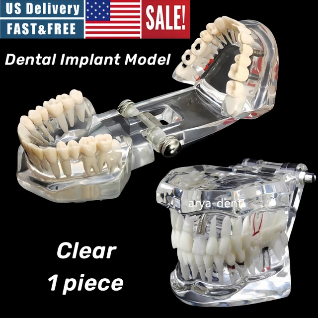 DENTAL IMPLANT TEETH Model Restoration Bridge Disease Teaching Study ...