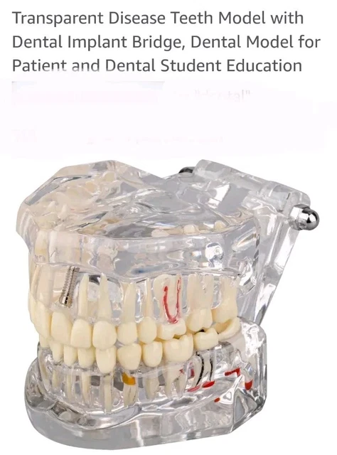 DENTAL IMPLANT DISEASE Model Teach Study Oral Teeth Bridge Restoration ...