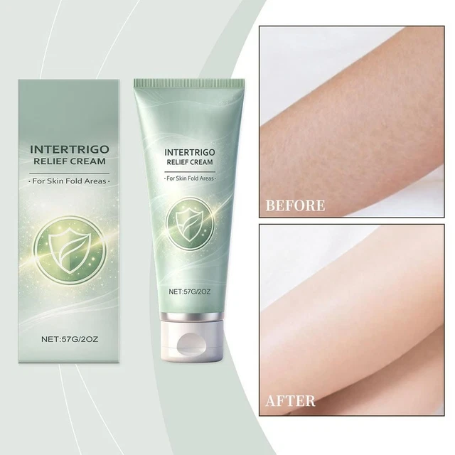 INTERTRIGO CREAM – Skin Fold Care & Chafing Support 2026 Cream HOT , £4 ...