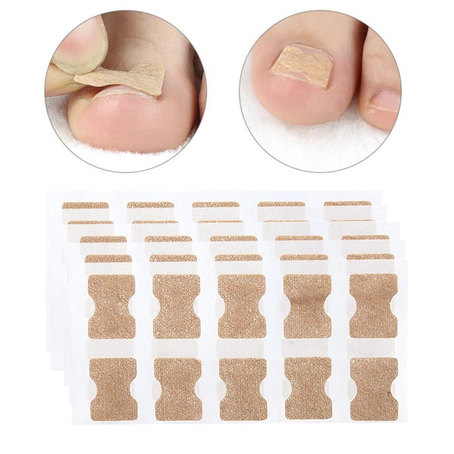 50 PIECE INGROWN Toenail Corrector Paronychia Treatment Tape Nail Care ...